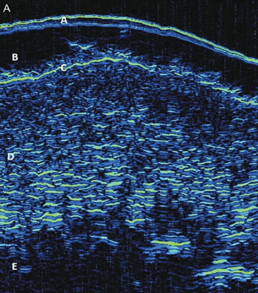 Технології NASHA \ OBT | Restylane